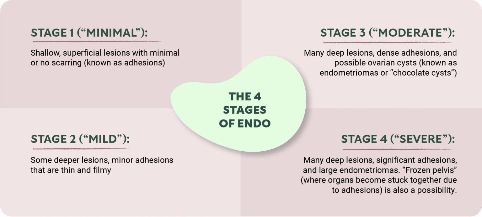 Stage 3 Endometriosis Explained: How Serious Is It?