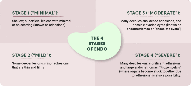 Stage 3 Endometriosis Explained: How Serious Is It?