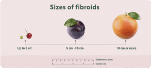 When and How to Seek a Specialist for Uterine Fibroids - ESSE Care